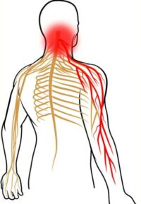 Radicular Pain Treatment and Therapy in West Des Moines IA